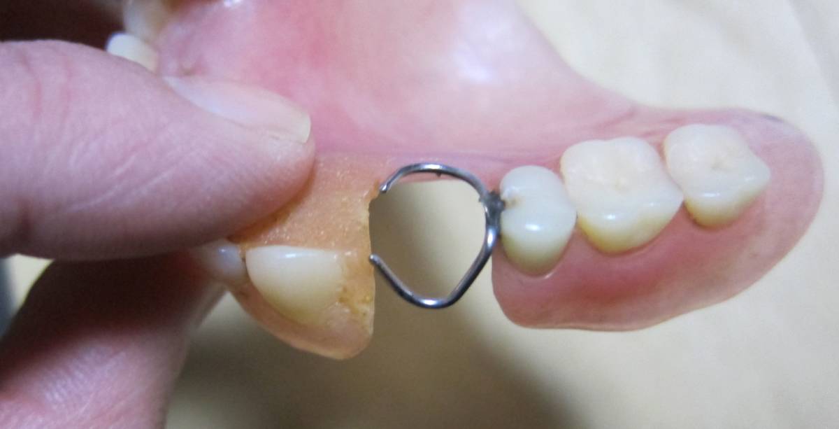 Yahoo!オークション - (0-1183)入れ歯