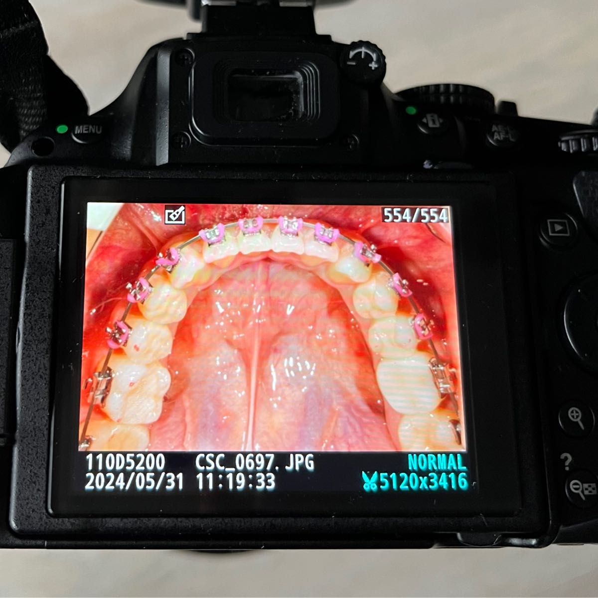 歯科用 口腔内カメラ 口腔内写真 デジカメ 一眼 マクロ リング 歯科用 口腔内カメラ 口腔内写真 デジカメ 一眼 マクロ リング